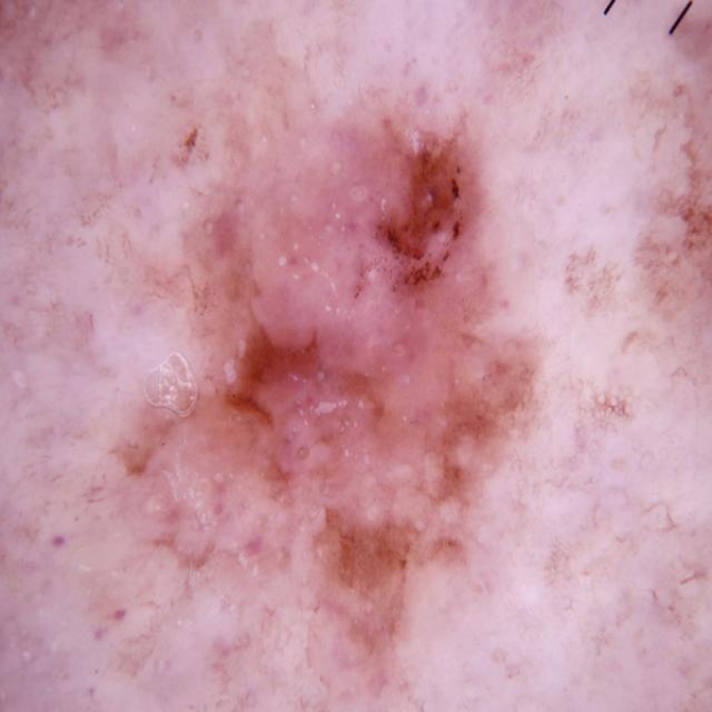 Skin Cancer Instance Segmentation Dataset By Konkukuniv