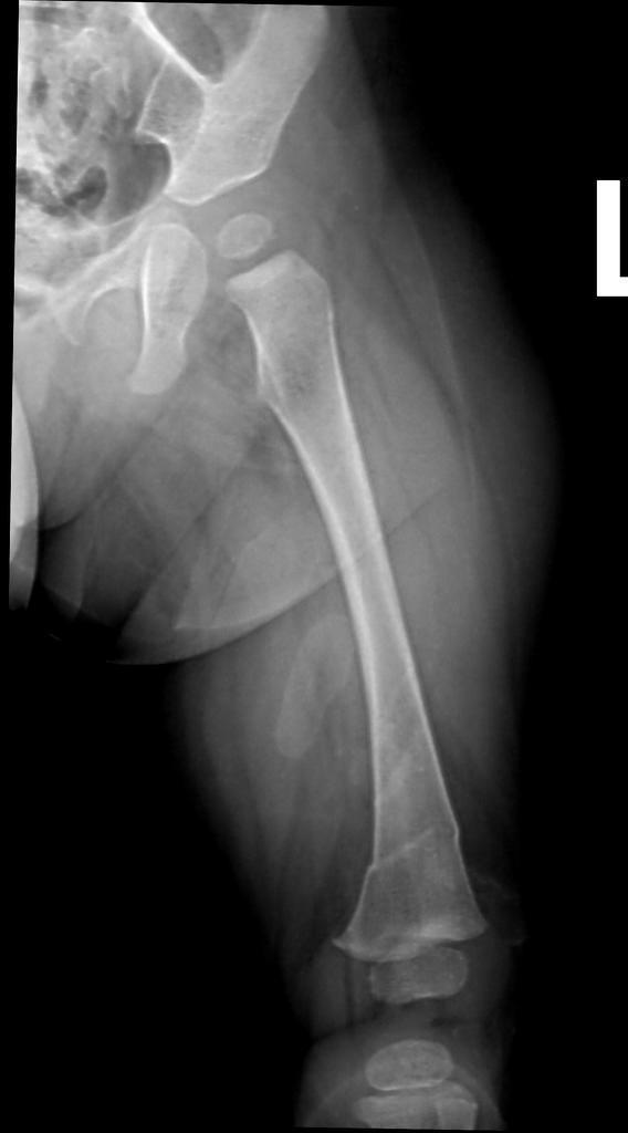 Bone Fracture Detection Object Detection Dataset By Pariparmar