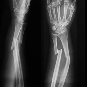 bone facture Object Detection Dataset by virat