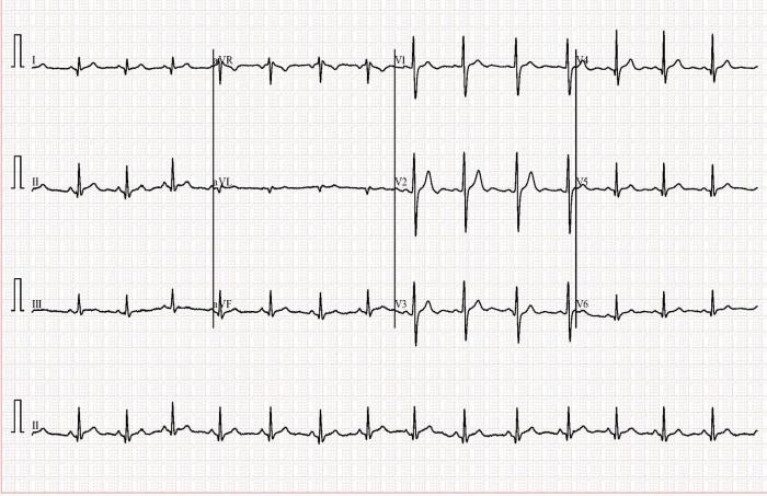 ECG Classification Dataset by deep learning