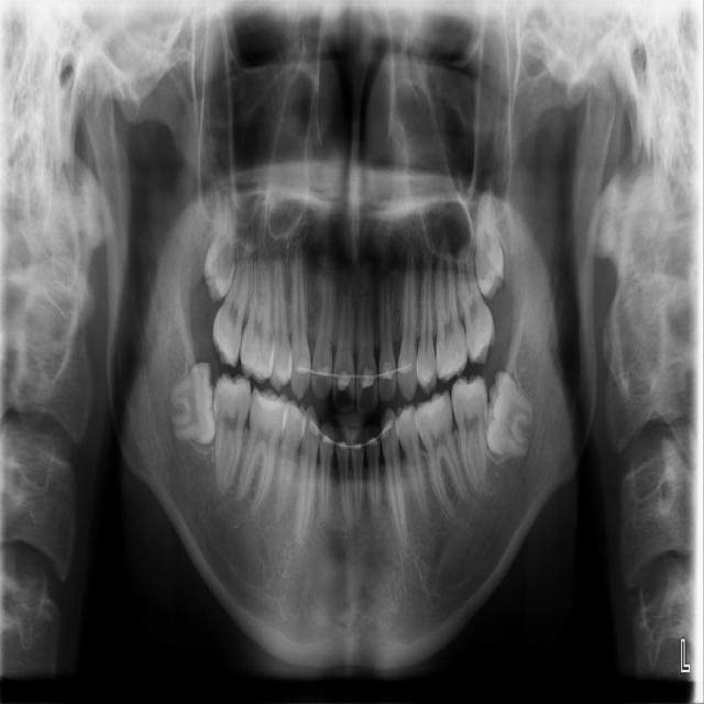 cariesseg Instance Segmentation Dataset (v3, 2024-07-30 9:21am) by ... cariesseg Instance Segmentation Dataset (v3, 2024-07-30 9:21am) by ...