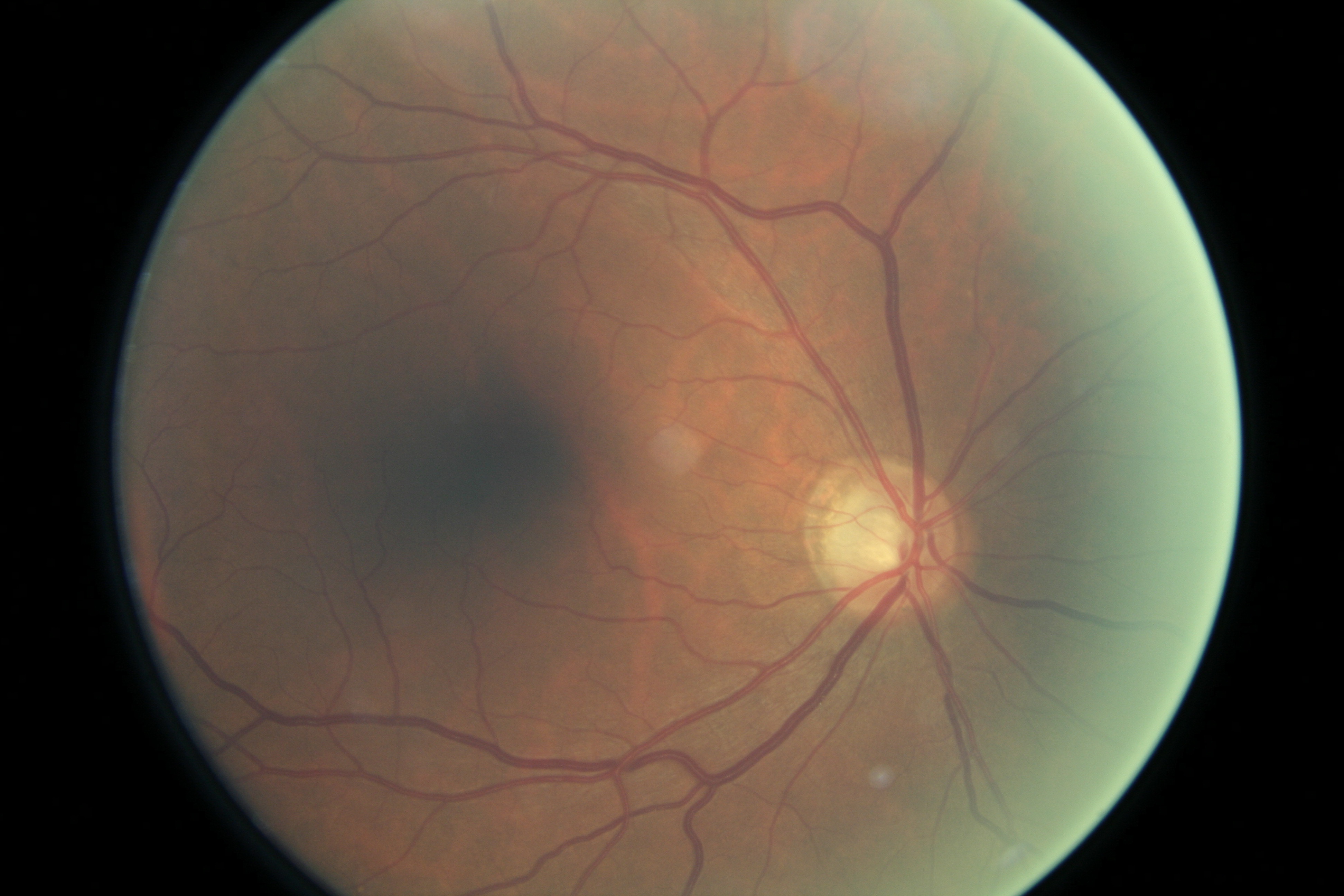 Dr Stages Classification Classification Dataset And Pre Trained Model