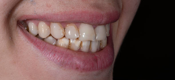 Calculus Dataset 2 Instance Segmentation Dataset by Image Segmentation