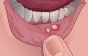 Ulcer Dataset 2 Instance Segmentation Dataset by Image Segmentation