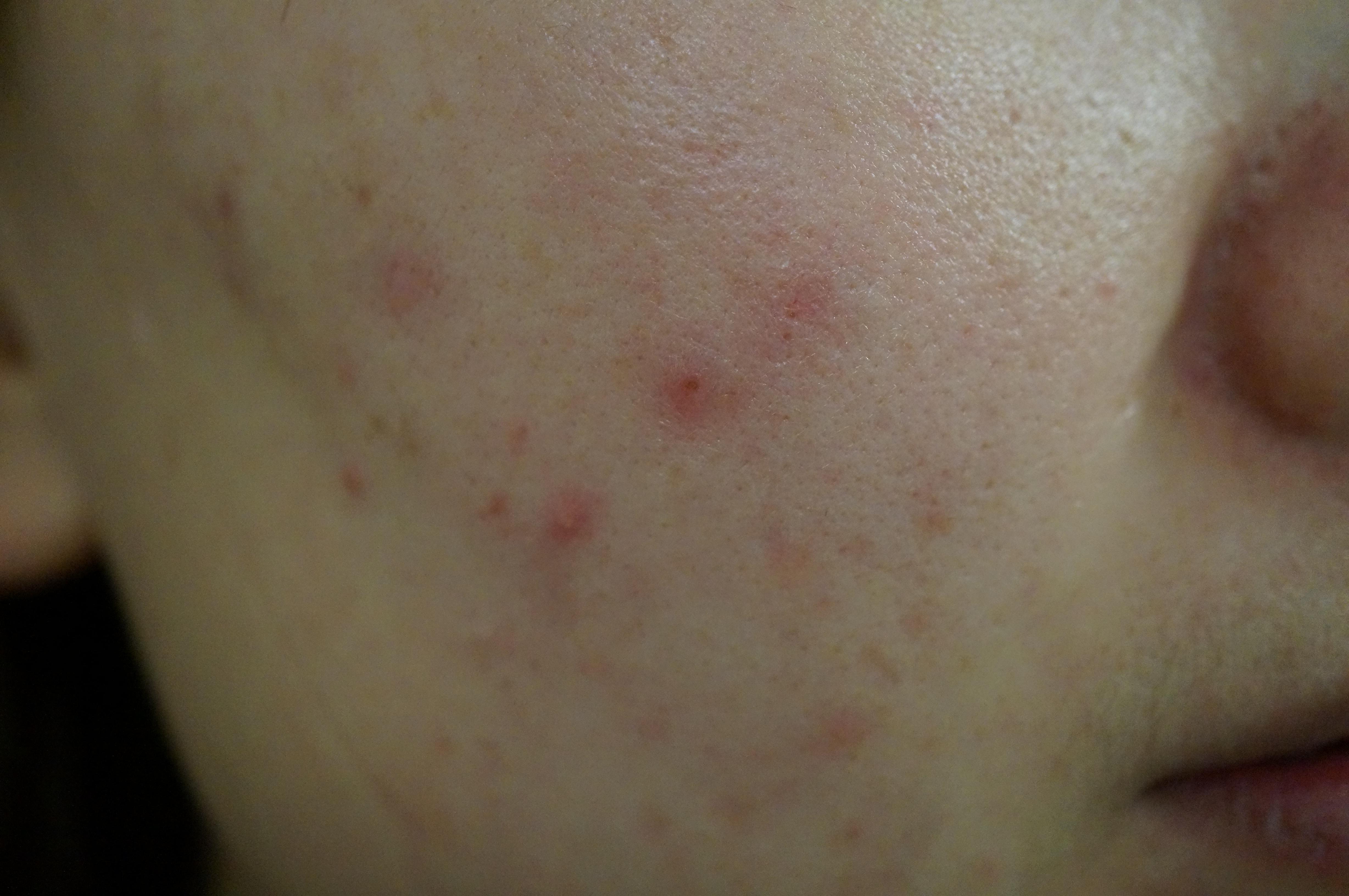 acne04 backup Object Detection Dataset by thesis