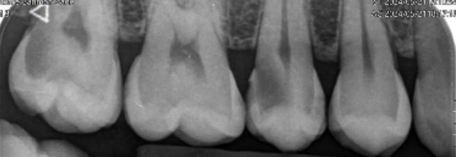 caries Instance Segmentation Dataset by Baasils workspace
