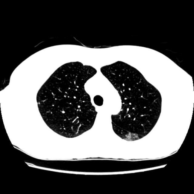 Cancer Lung Object Detection Model V6 2025 01 22 2 02pm By Abod