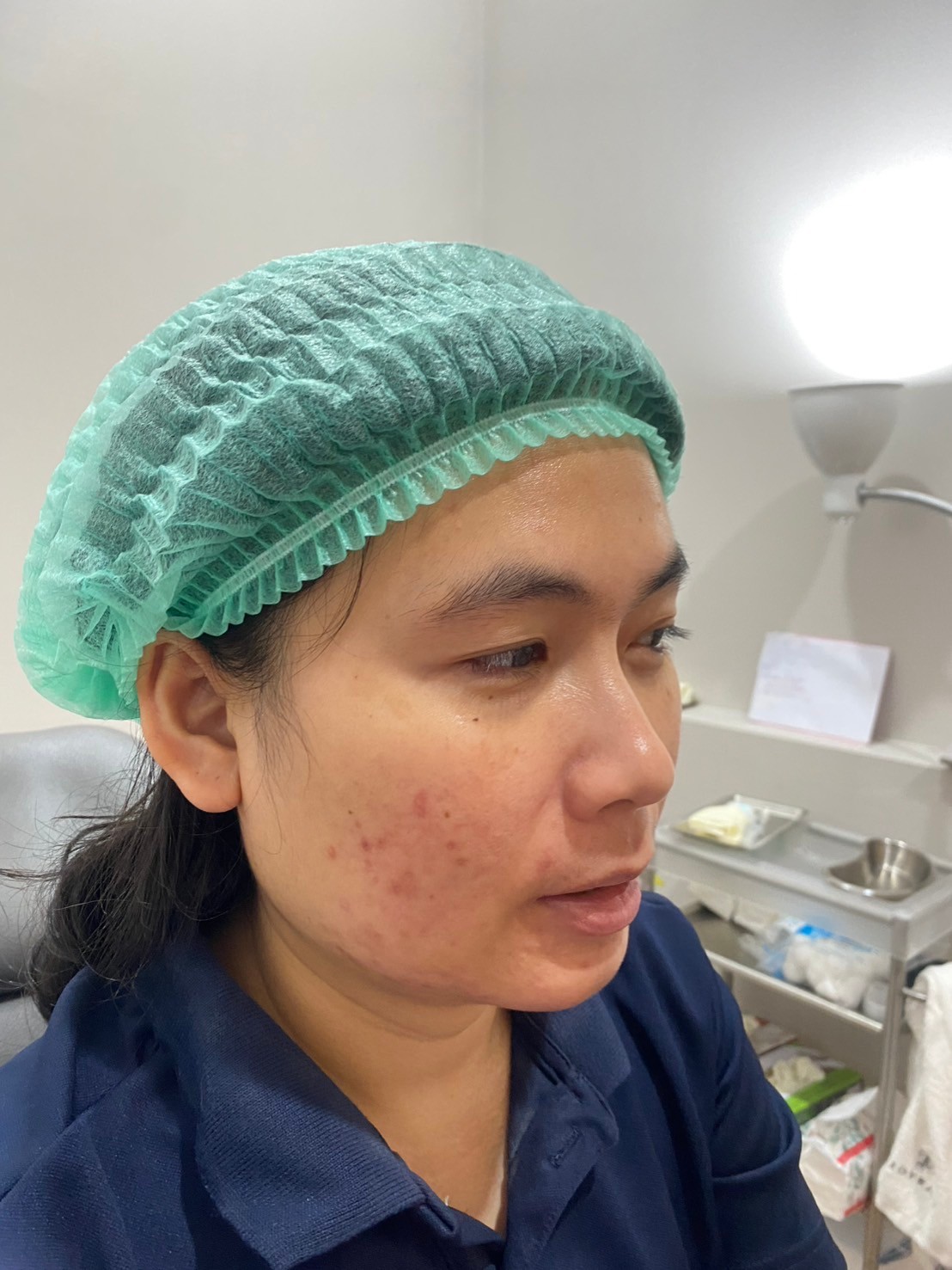 Acne Detection Dataset And Pre Trained Model By Acne Service
