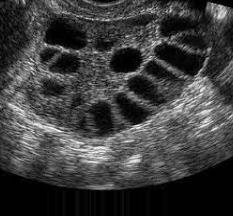 Project pcos Object Detection Model by VanessaS