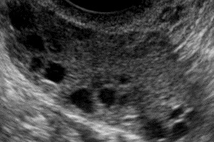 PCOS Object Detection Model by VanessaS