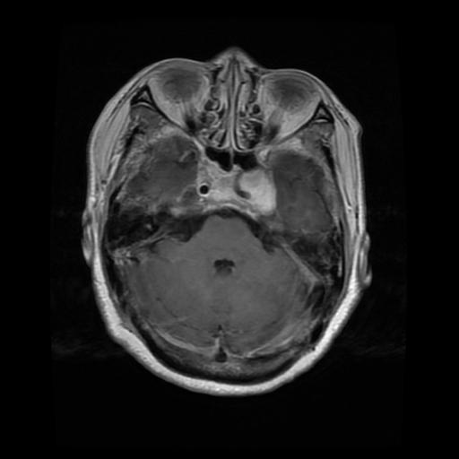 brain tumor detector Object Detection Dataset by yuvraj jaiswal brain tumor detector Object Detection Dataset by yuvraj jaiswal