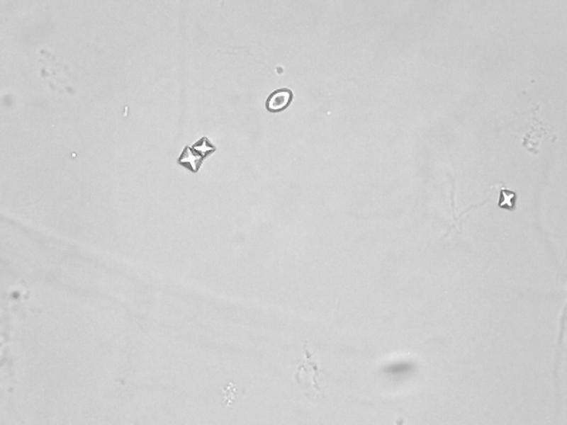 urine crystal shape Instance Segmentation Dataset by urine