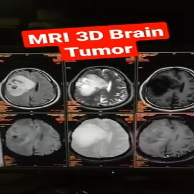 Brain Tumor Detection Object Detection Model by workersafetyml