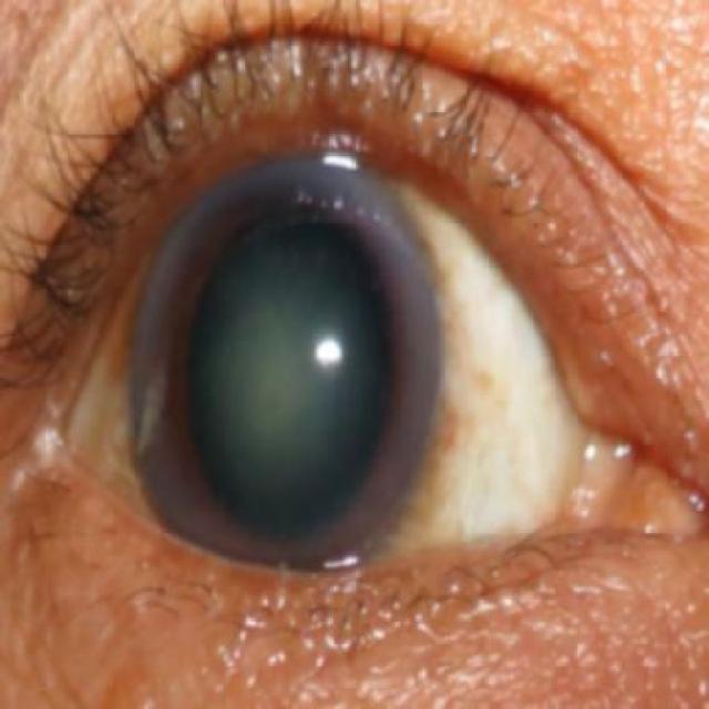 Cataract-Detection Classification Model by FY Project