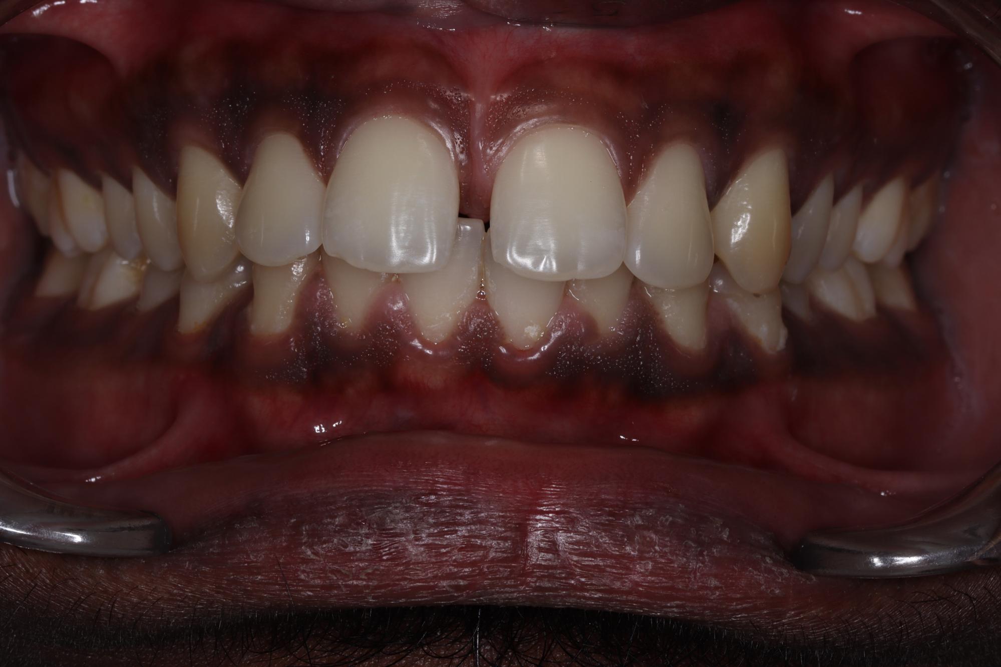 MIDLINE SHIFT detection Object Detection Dataset by Rocky