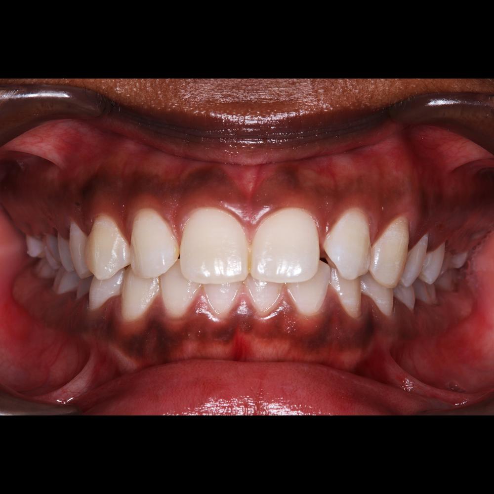 MIDLINE SHIFT SEGEMENTATION Classification Dataset by Rocky