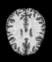 Very Mild Demented Object Detection Dataset (v1, 2022-08-12 12:53pm) by ...