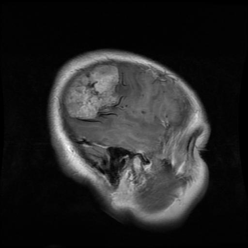 Brain Tumor Detection Object Detection Dataset And Pre Trained Model By