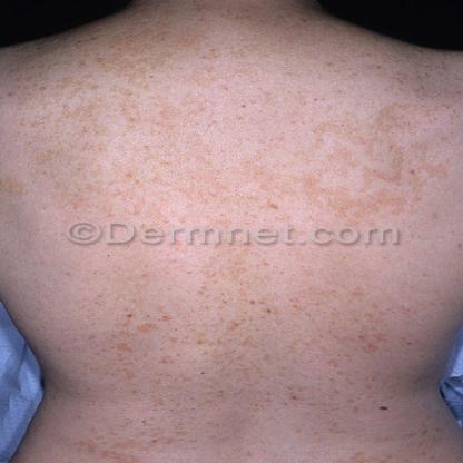 Skin Object Detection Dataset and Pre-Trained Model by wound