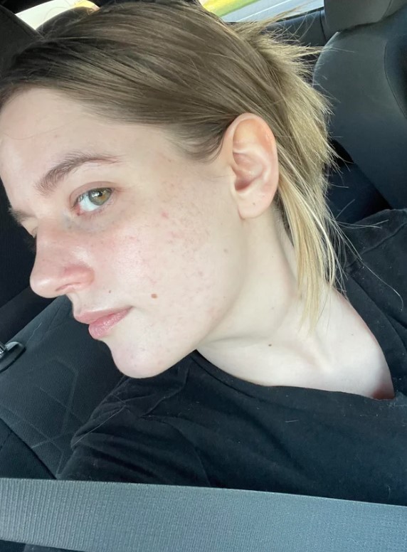 How To Use The Acne Object Detection Api