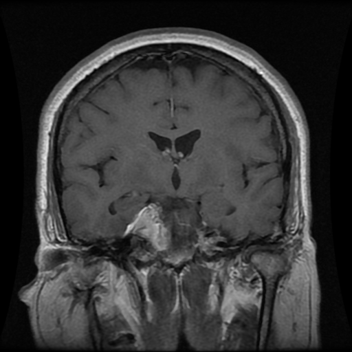 Brain Cancer Detection Instance Segmentation Dataset by teach