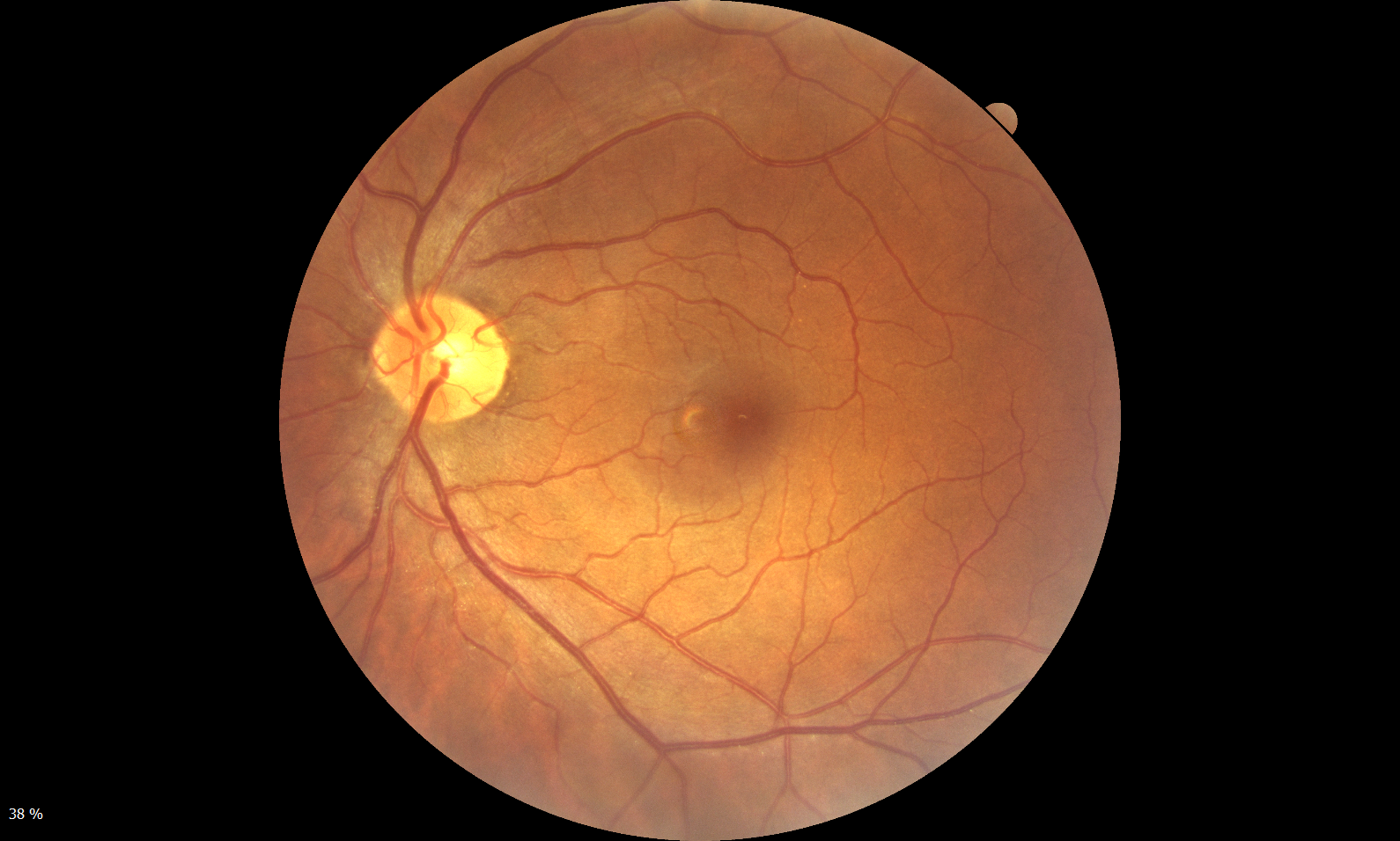High Myopia Dataset Classification Model by ldallastaworkspace