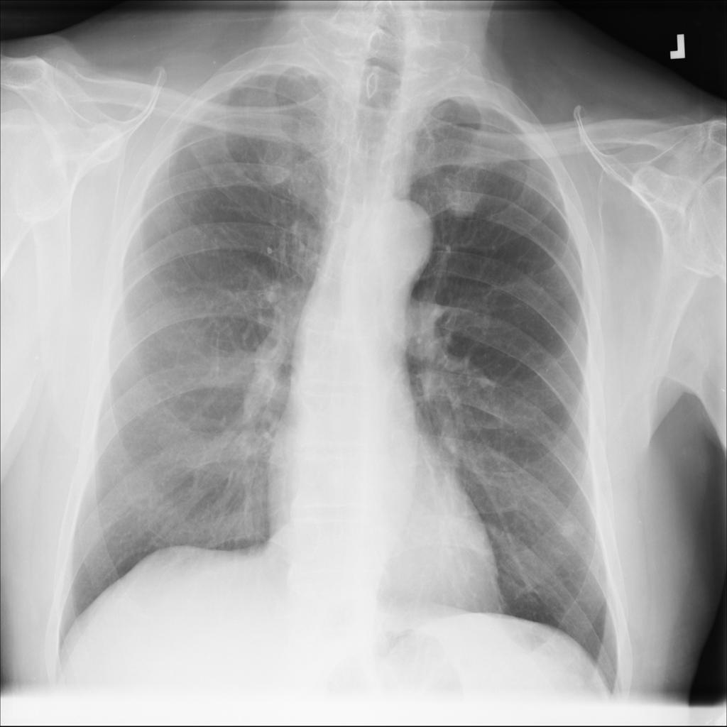 Chest nodule Object Detection Dataset and Pre-Trained Model by honeia