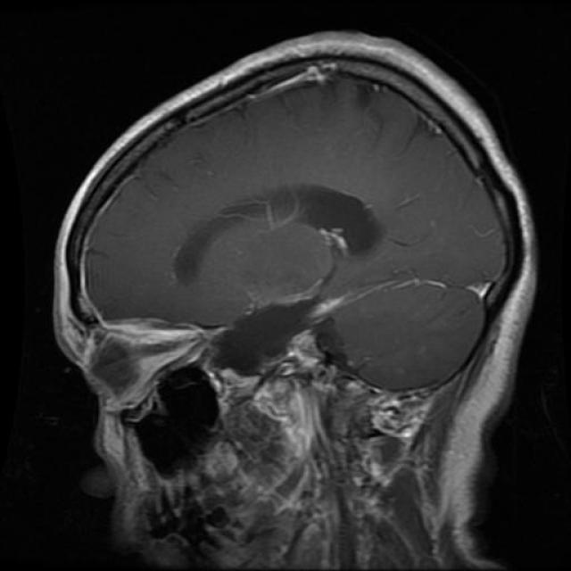 How to Use the BRAIN TUMOR Instance Segmentation API
