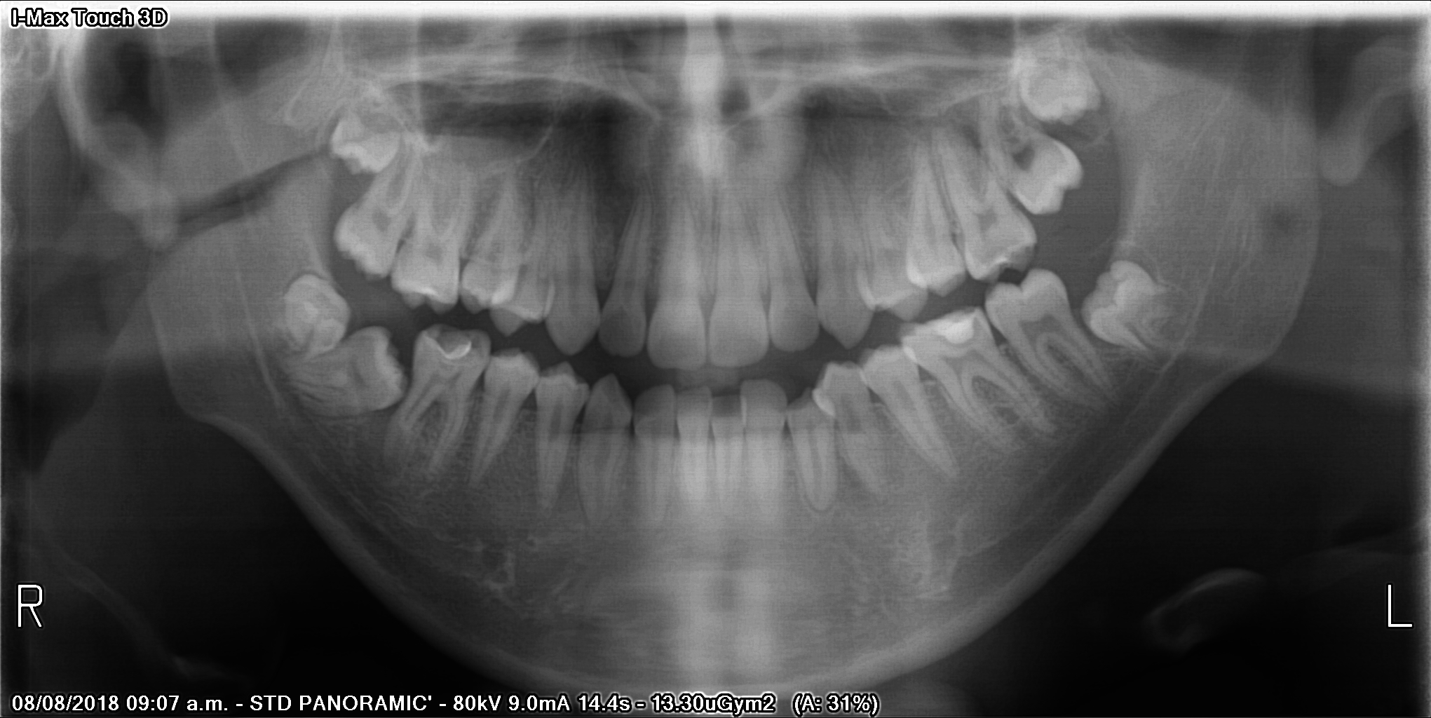 dental panorama xray 3 Object Detection Model by ansanailab