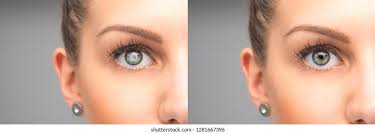 Eye Diseases Dataset Classification Dataset by Eye Disease Dataset