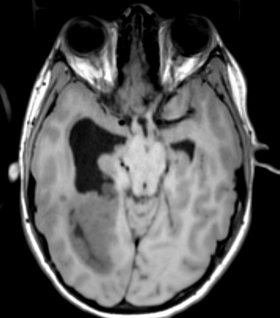 MRI Classification Classification Model by MRI Analysis