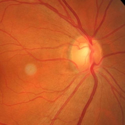 Glaucoma observations Classification Dataset by Alexandria University