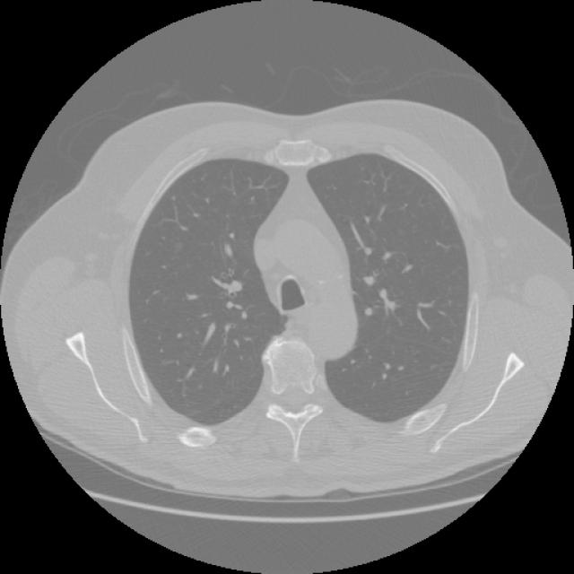 Breast Cancer Detection (breast-cancer-detection-sdfre) - Roboflow Universe