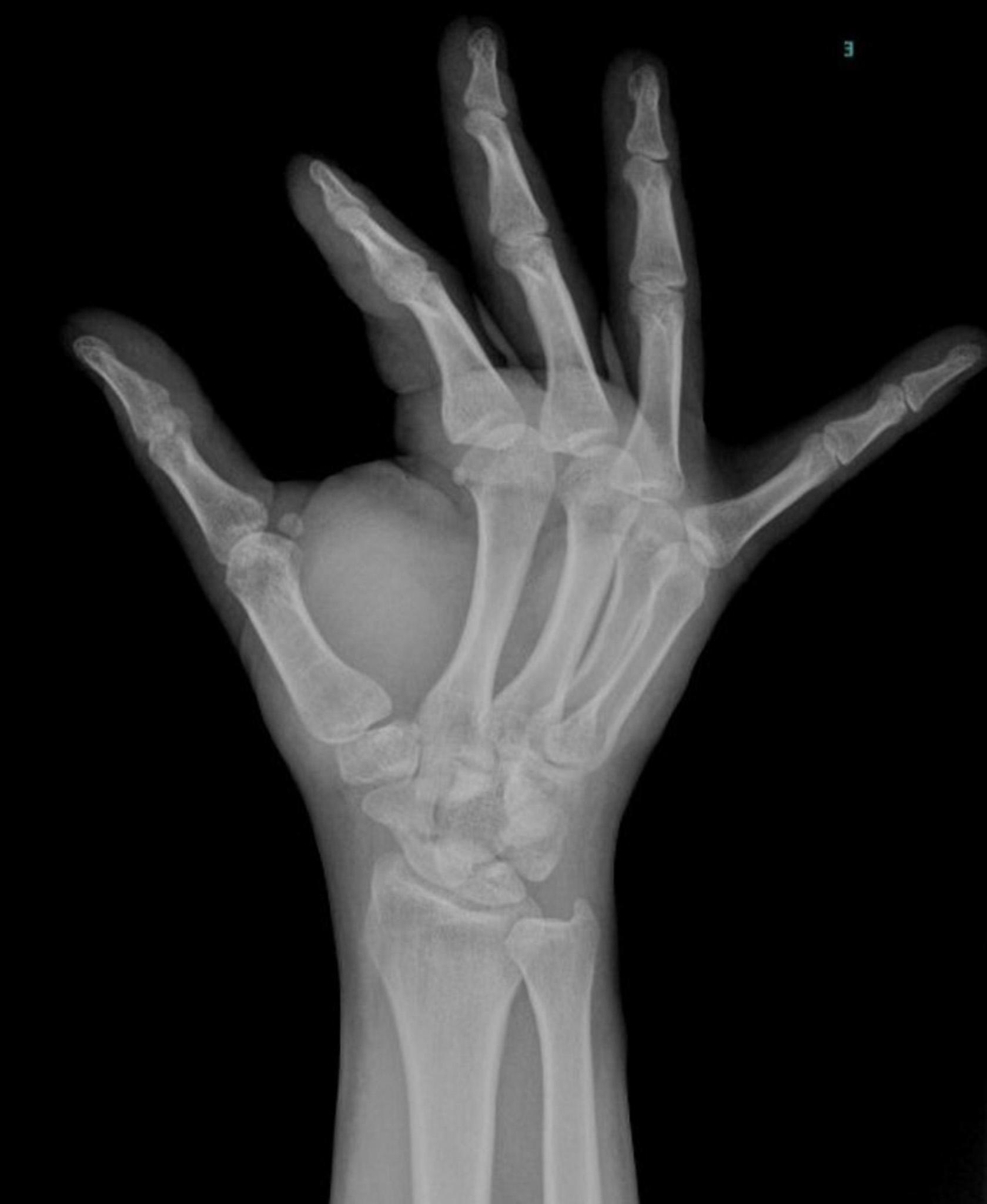 scaphoid-internet-Oblique Object Detection Dataset by NiLuan