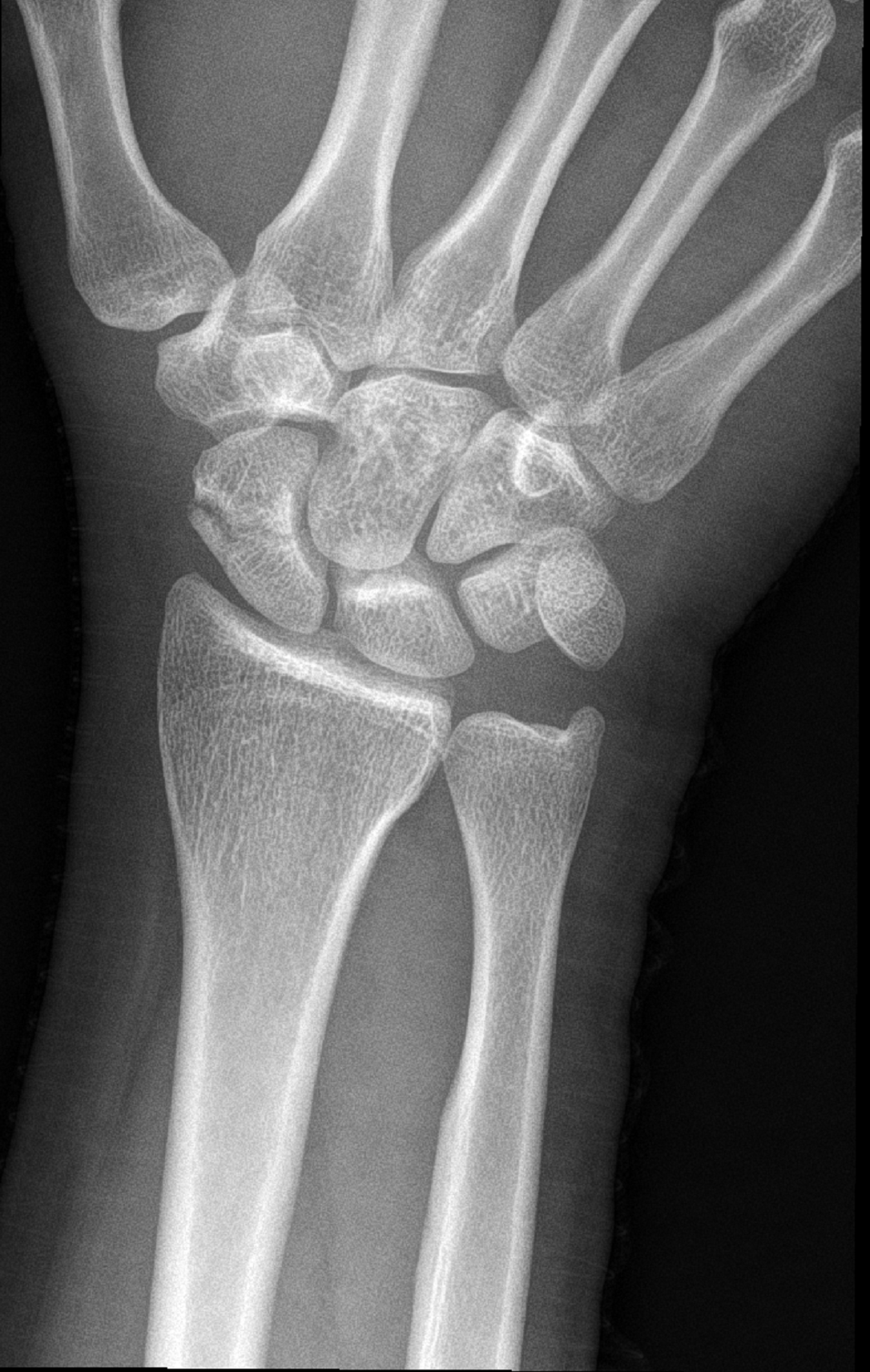 scaphoid-radiopedia-AP Object Detection Dataset by NiLuan