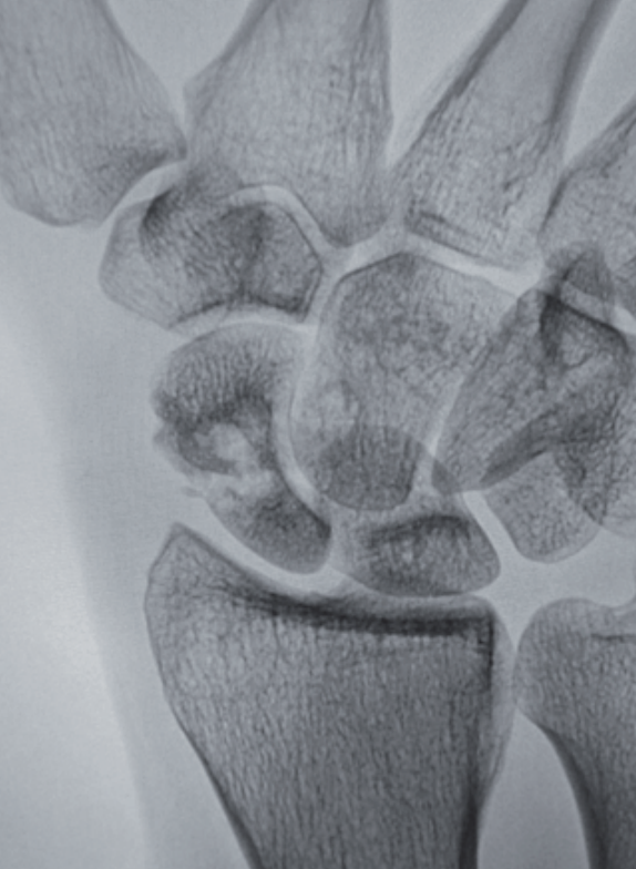 zOld_scaphoid-internet-AP Object Detection Dataset by NiLuan