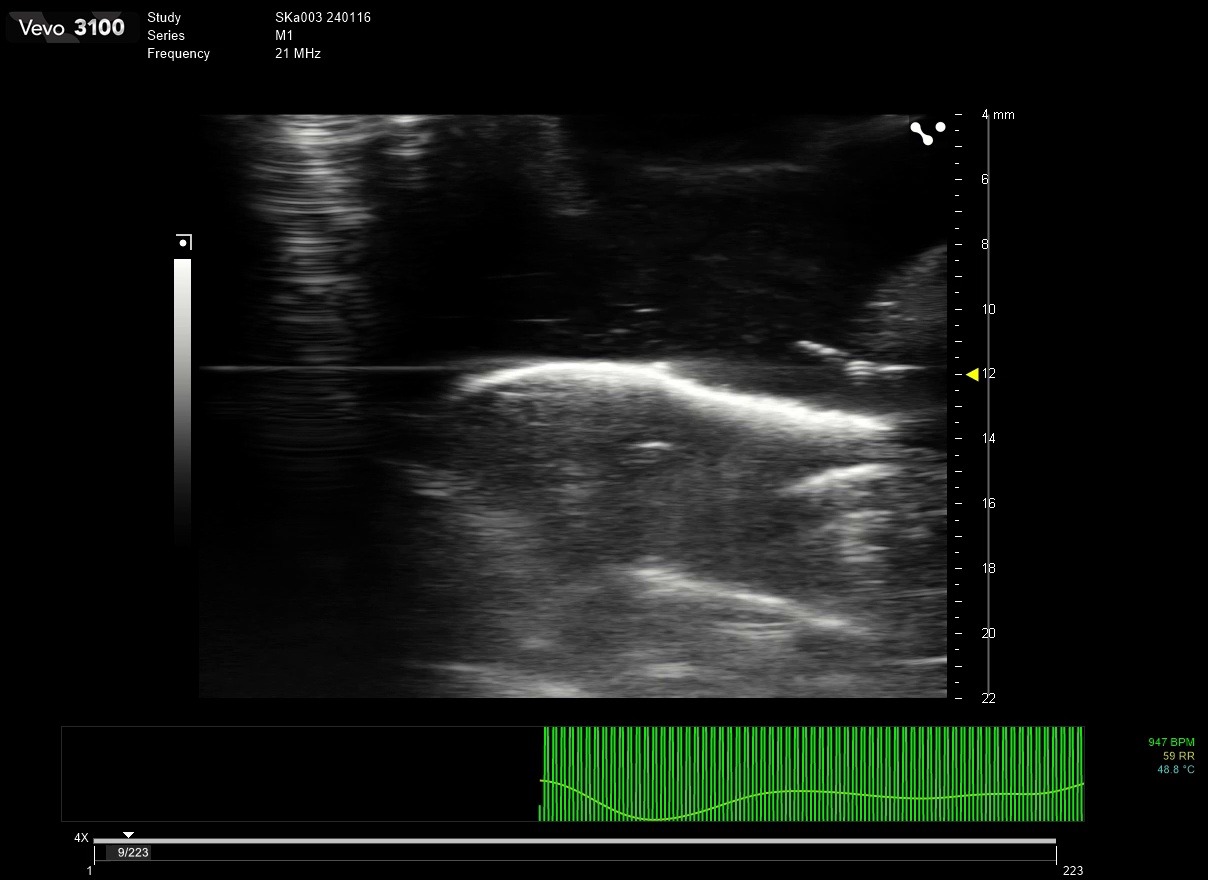 Tumor-Ultrasound Instance Segmentation Dataset and Pre-Trained Model by Zanto