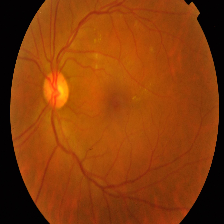 Retinal Detection Classification Dataset by Rais
