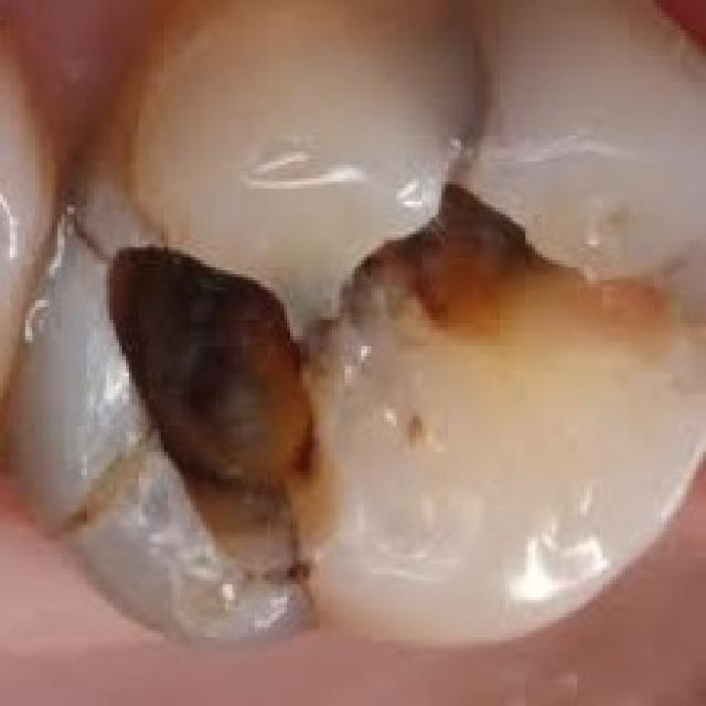 tooth cavities Object Detection Dataset by team9