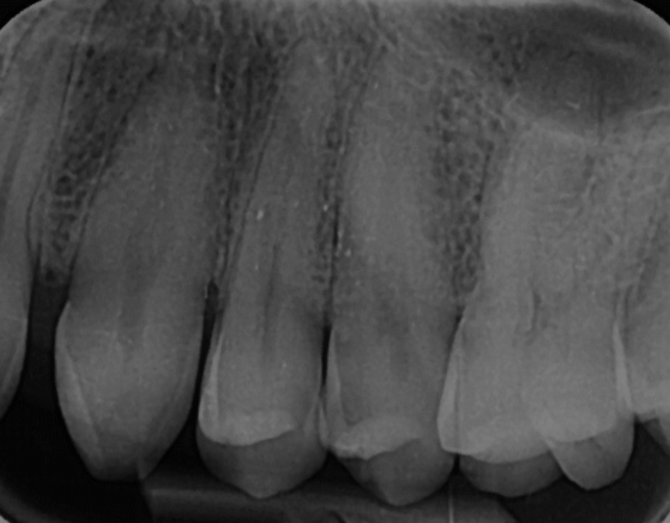 Individual Bone Loss Segmentation 1 Semantic Segmentation Dataset By Periodontitis