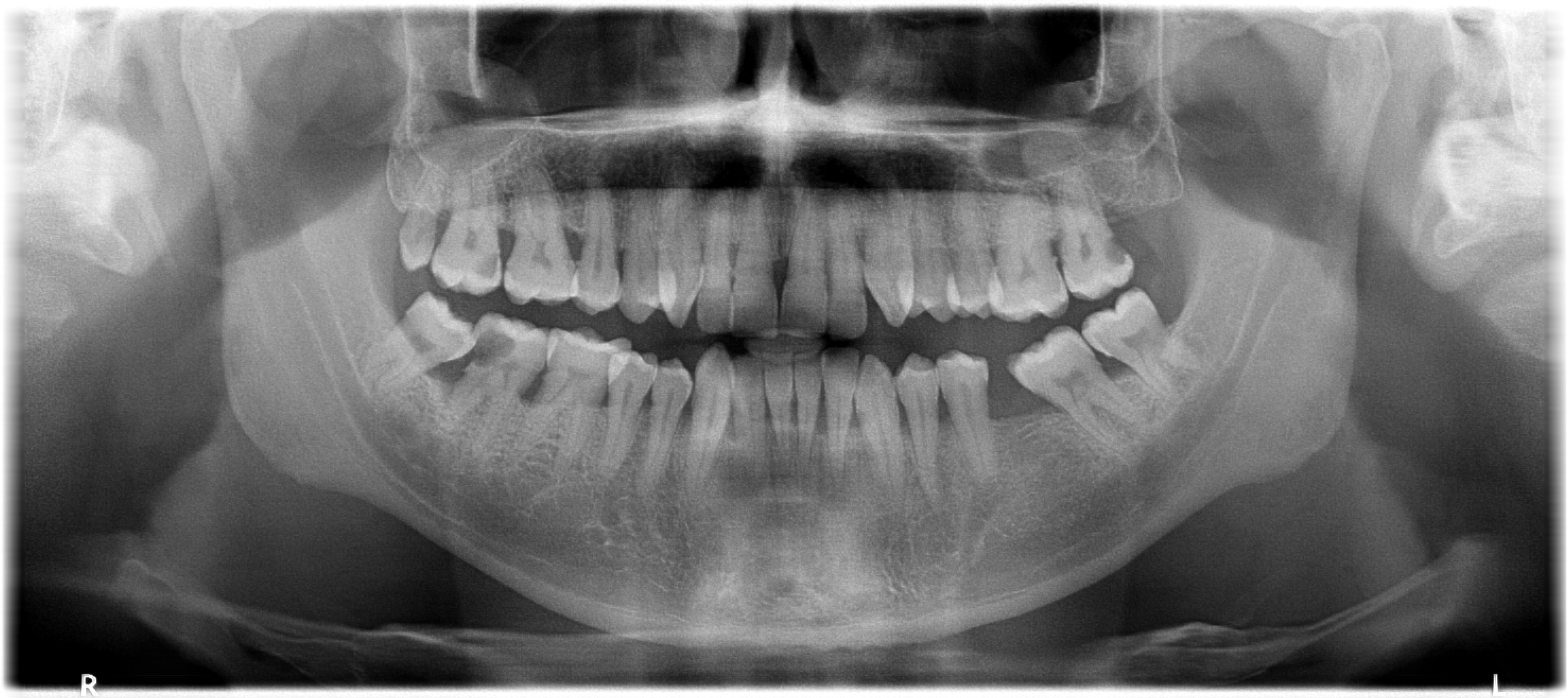 Dental Xrays Object Detection Dataset By Periodontitis