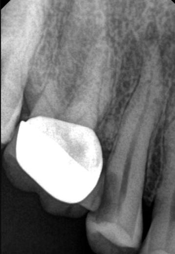 DENT Object Detection Dataset by periodontitis