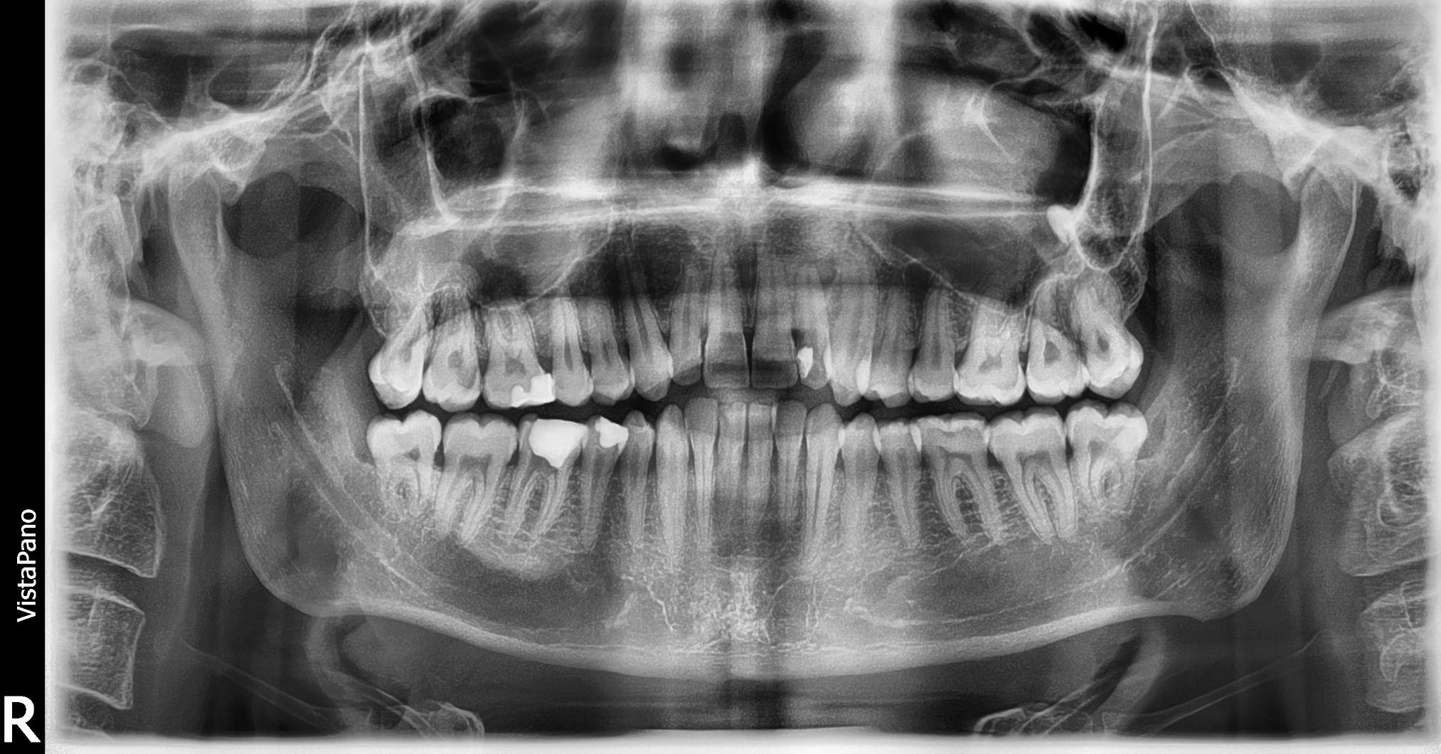 Periapical Lesion Augmented Object Detection Dataset By Periodontitis