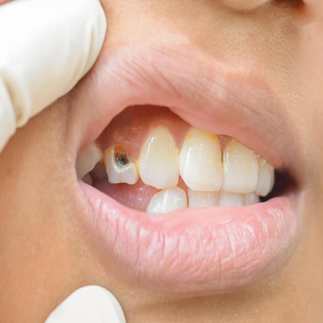 Frontals ICDAS Merged Object Detection Dataset by Tooth Detection