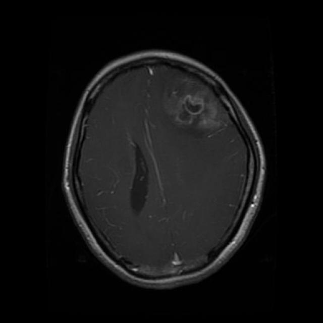 MRI Classification Classification Dataset by MRI