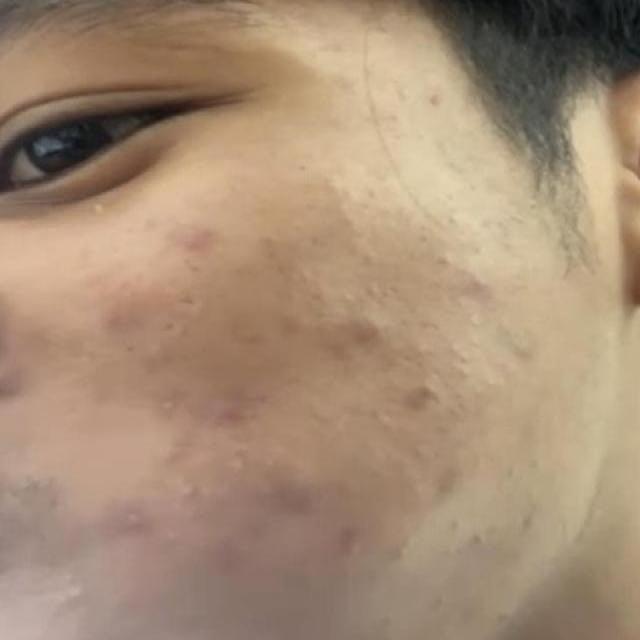 Acne Wrinkles Segmentation Instance Segmentation Model By Harsh