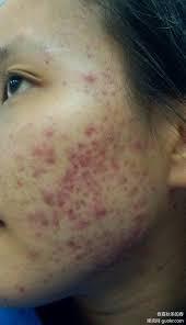 acne_ACNE04 Object Detection Dataset by Yolo