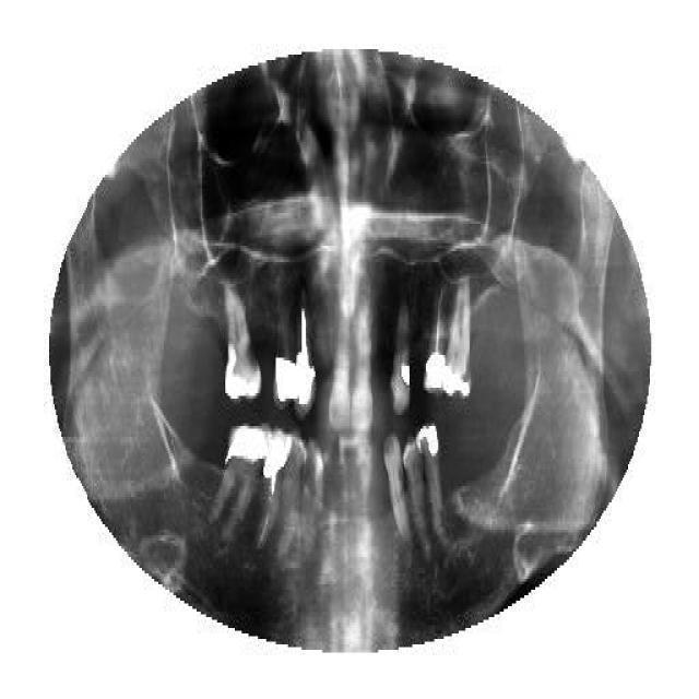 panoramic-xray-image Object Detection Dataset and Pre-Trained Model by teeth detection using yolo