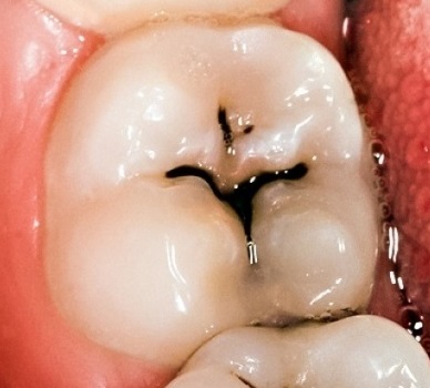 mydata Object Detection Dataset by teeth detection using yolo