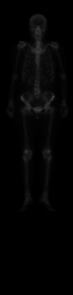 Bone Scan Cancer Segmentation Semantic Segmentation Dataset by Oktos